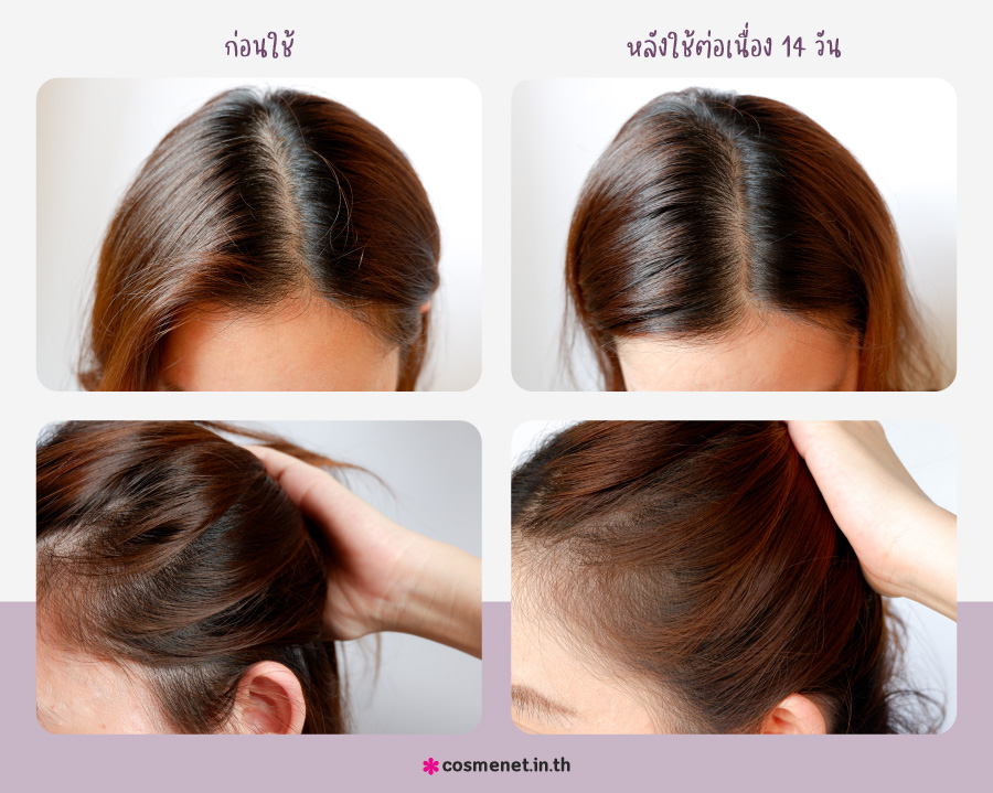 ล็อครากผมให้สตรองใน 14 วัน ด้วยเซ็ตแชมพูลดผมร่วง CLEAR SCALPCEUTICALS ...